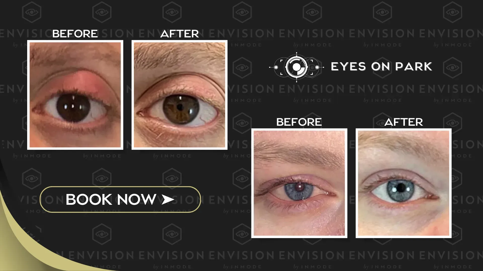 Dry Eye Treatment in NYC: Advanced Care at Eyes On Park